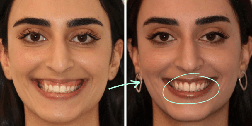 Gummy Smile Treatment | Gum Lift & Contouring Melbourne